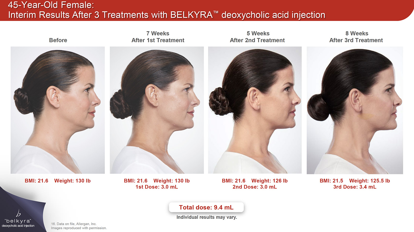 Belkyra (Kybella) Double Chin Treatment – Toronto Plastic Surgery