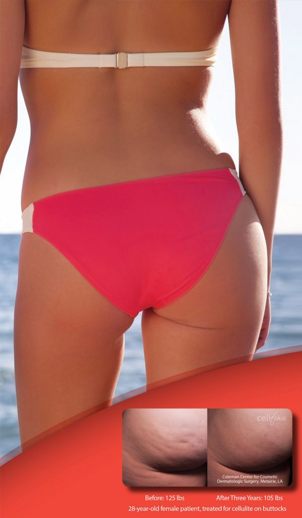 CellfinaTM Cellulite Treatment - Toronto Plastic Surgery